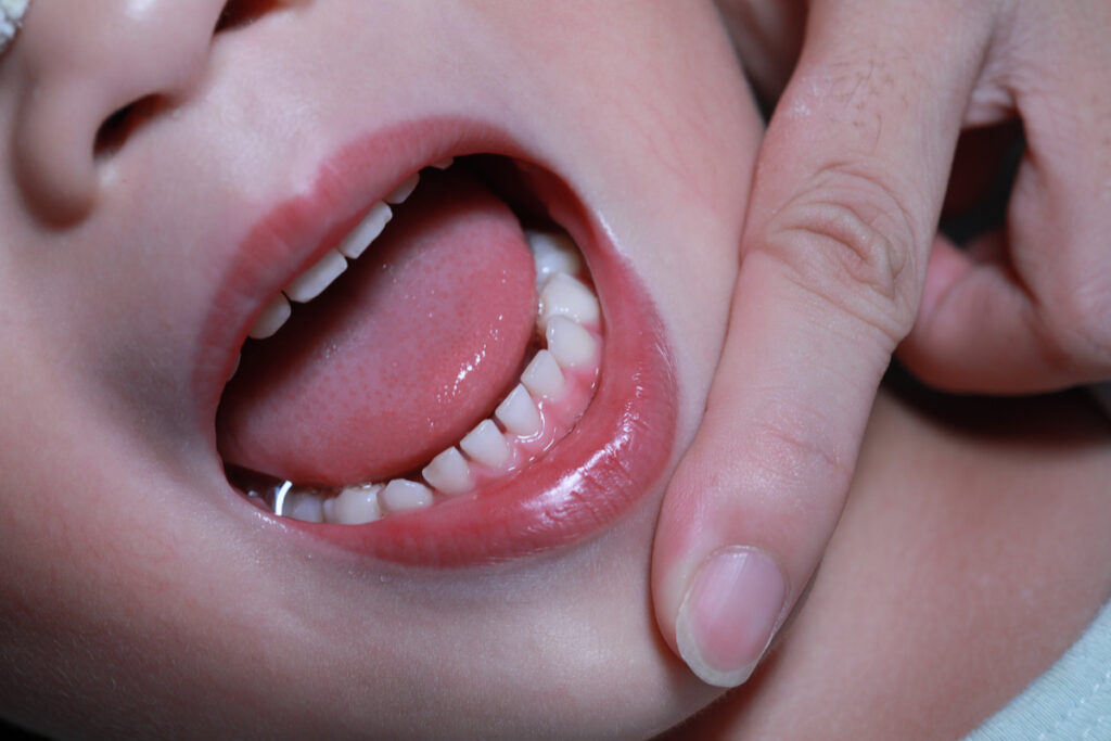 The Timeline of Tooth Development: What to Expect from Ages 0-18 ...